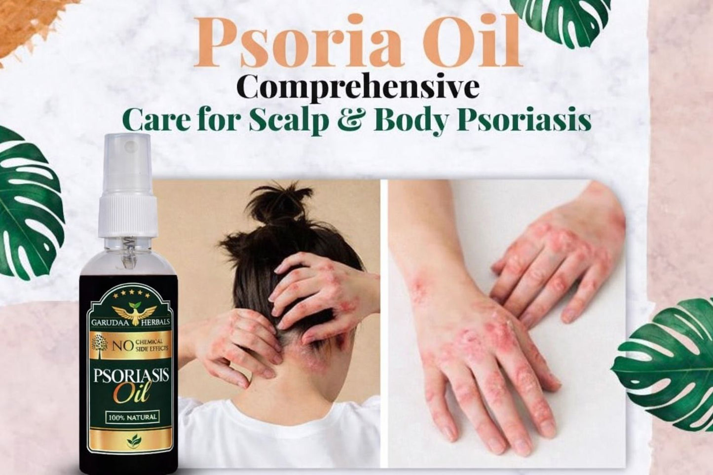 Garuda Herbal Psoriasis Oil-Advanced Psoriasis Clearing Oil – RABBIT ...